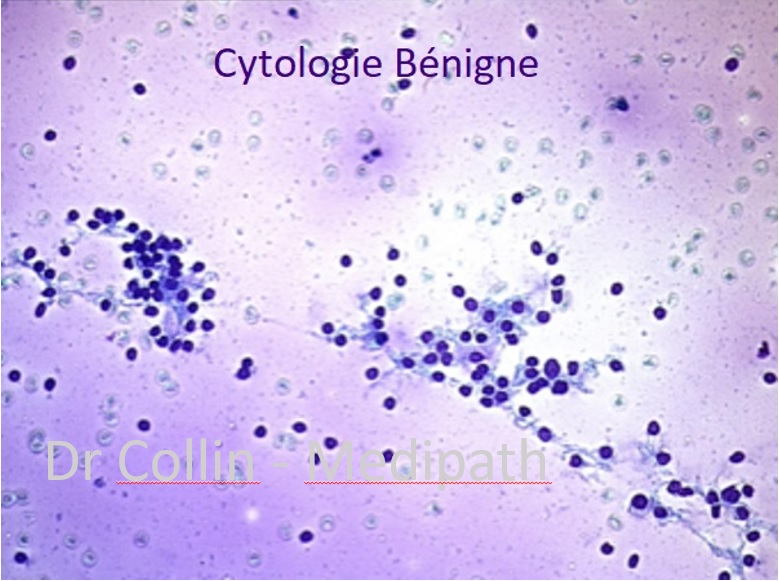 Cytologie Dr Collin – Toulouse Thyroide